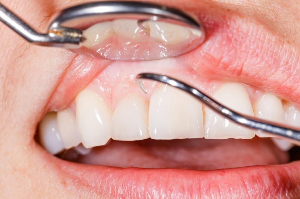 Dentist M8W 1N6 | What Can I Expect When You Treat My Gum Disease?